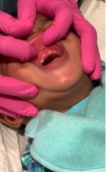 How to Tell if Your Baby Needs A Infant Frenectomy - According to April ...